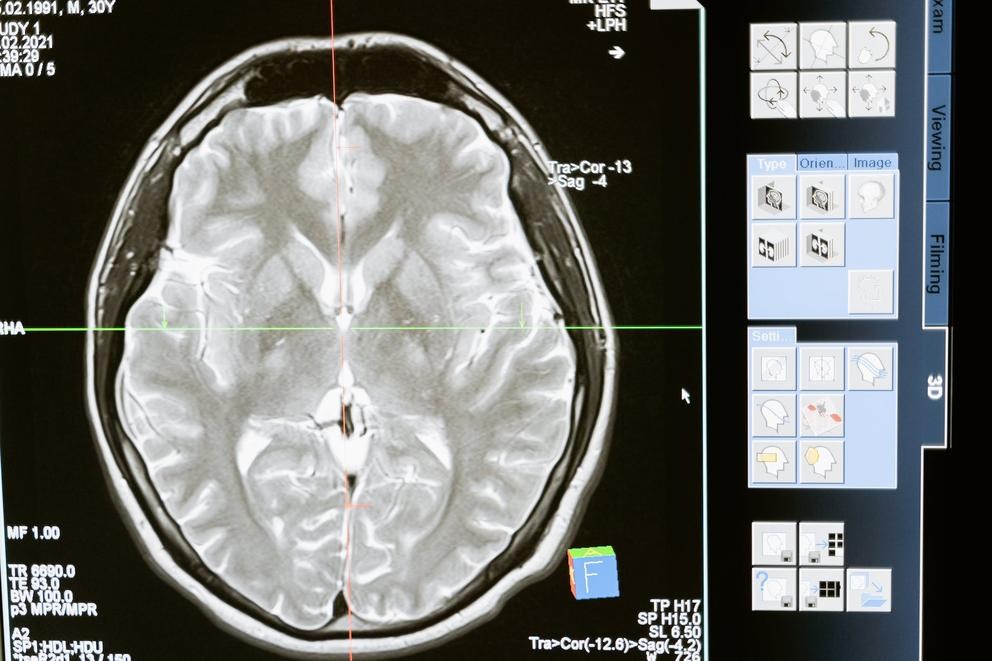 Brain Scans and Dyslexia: Can It Be Detected?